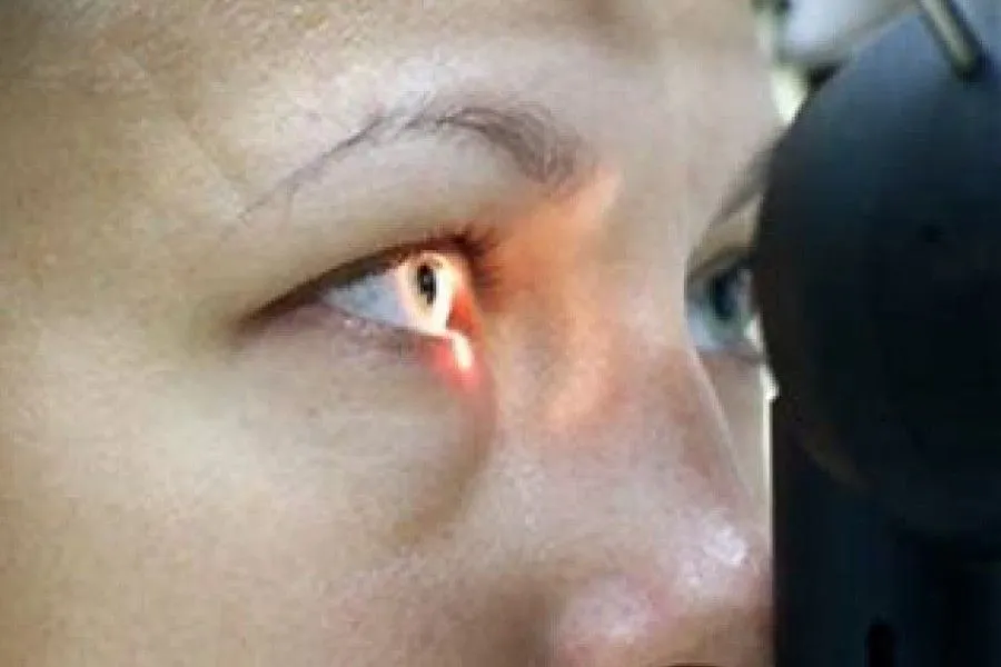 Amaurosis Fugax: Symptoms, Causes, Diagnosis & Treatment - Tender Palm ...