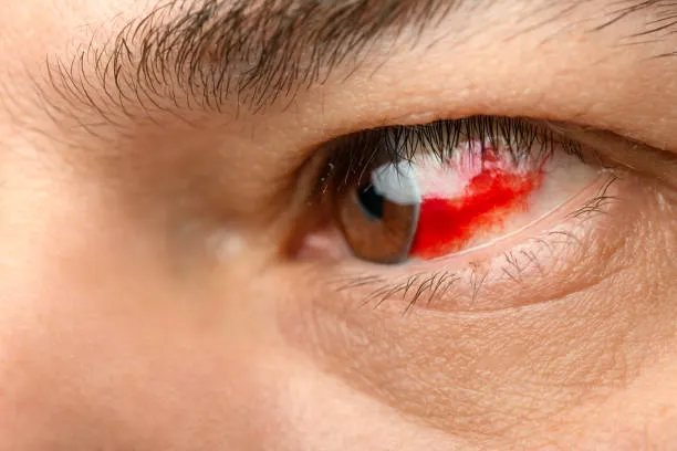 Retinal Hemorrhage: Symptoms, Causes, Diagnosis & Treatment - Tender ...