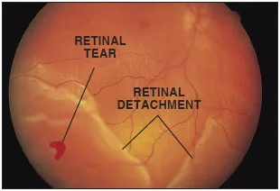 Retinal Tear: Symptoms, Causes, Diagnosis & Treatment - Tender Palm Eye ...