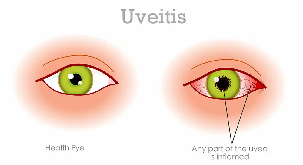 Uveitis: Symptoms, Causes, Diagnosis & Treatment - Tender Palm Eye Hospital Lucknow, India